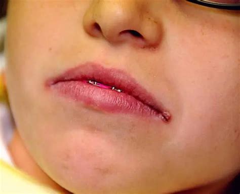 Angular Stomatitis Seizures In The Corners Of The Mouth Causes And