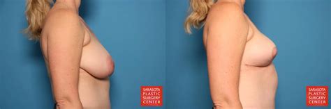 Breast Reduction Before And After Gallery Patient 21