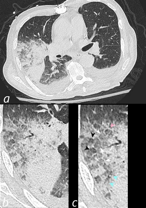 Lung Hemorrhage Lungs