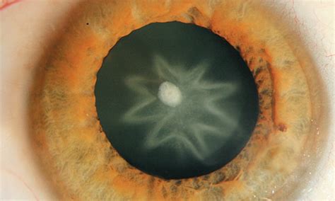 Floriform Cataract