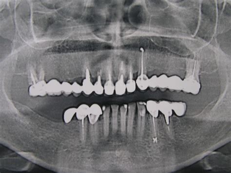 Restoration Of Maxillary Dentition Defect Alpha Dent Implants