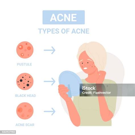 Ilustración De Diferentes Tipos De Acné De La Piel Facial Y Más