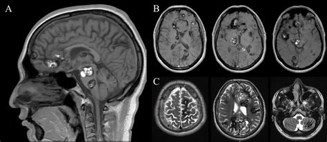 Mri Sagital T1 A And Axial T1 B And T2 C Images That Show