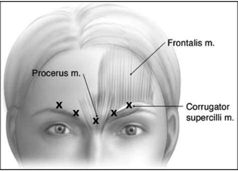 Single Dose 5 Point Intramuscular Injection Pattern Download