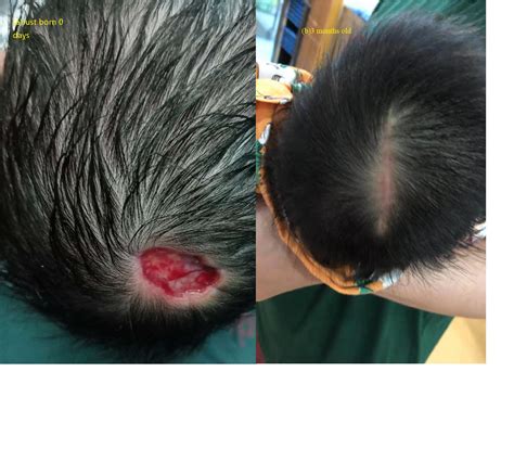 Isolated Aplasia Cutis Congenita Case Report Of Two Cases Authorea