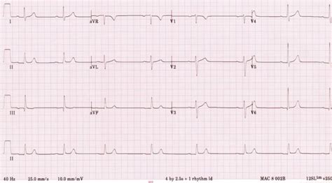 Brash Syndrome • Litfl • Ccc