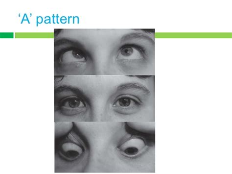 A V Pattern Strabismus