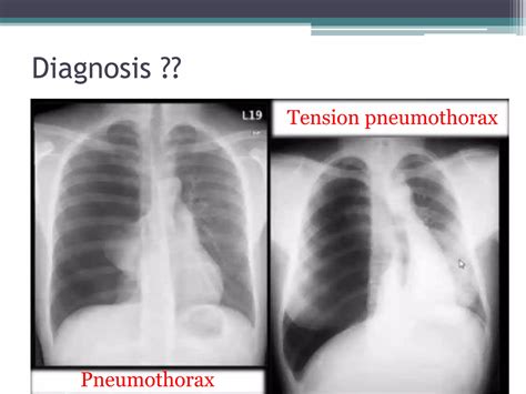 Imaging In Pneumothoraxpptx