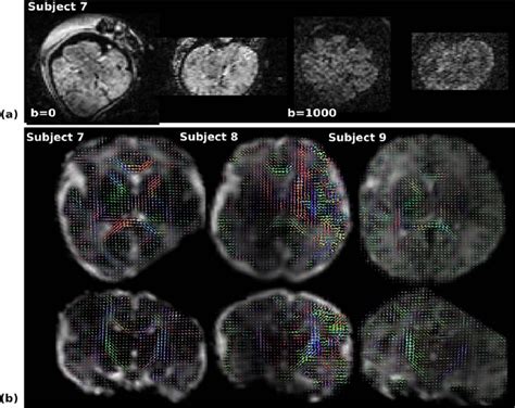 Illustrative Results For Subjects 79 From The 6 Shell Hardi Protocol