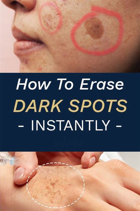 How To Get Rid Of Dark Spots At Home Naturally Read More