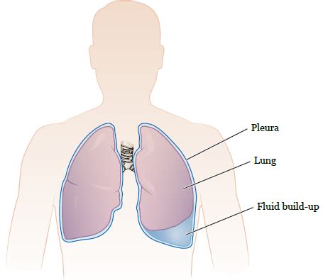About Your Pleurx™ Drainage Catheter Memorial Sloan Kettering Cancer