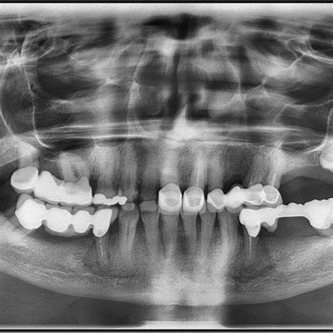Pdf Lymph Node Abscess Caused By Francisella Tularensis A Rare Differential Diagnosis For