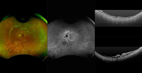 Retinal Detachment 9