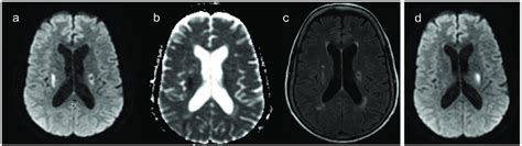 Right Sub Insular Diffusion Restriction A With Adc Correlation B