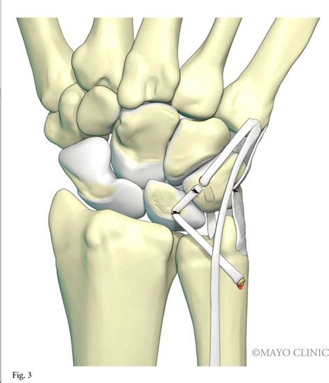 Figure 3 From Reconstruction Of Triangular Fibrocartilage Complex Avulsions Palmar 1c With