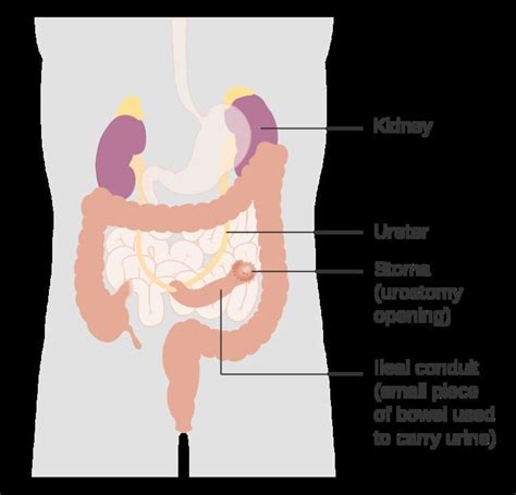 Urostomy Alchetron The Free Social Encyclopedia