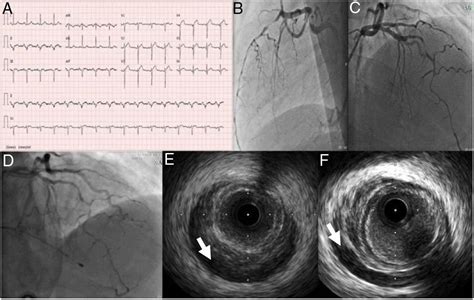 Spontaneous Coronary Artery Dissection “to Stent Or Not To Stent That