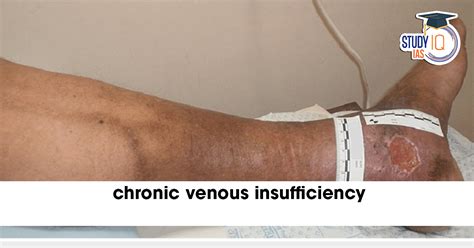 Chronic Venous Insufficiency Symptoms Risks And Treatment
