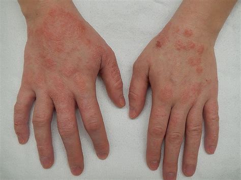 Nh Ng Th Ng Tin B N C N Bi T V B Nh Vi M Da Ti P X C