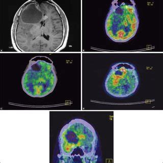 A Post Contrast MRI Shows Low Grade Glioma Rt Temporal Lobe B No Download Scientific