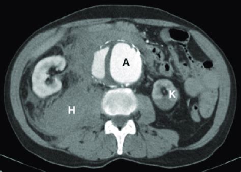 Ct Scan Demonstrating A Juxtarenal Abdominal Aortic Aneurysm A With