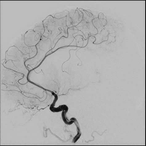 File Proximal Right Mca M1 Segment Embolic Occlusion Radiopaedia 56974 63841 Lateral Baseline
