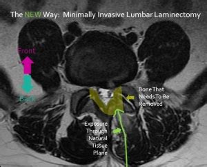 Lumbar Laminectomy Texas Minimally Invasive Spine Surgery Dr Shaad