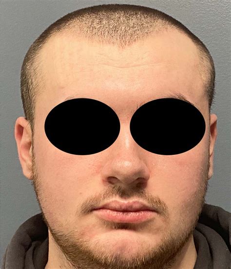 Male Temporal Red Front 1 Dr Barry Eppley Copy Explore Plastic Surgery