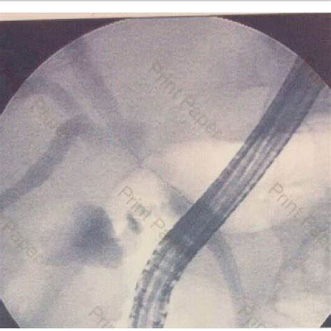 Ercp Show Stricture Of Common Hepatic Duct Just Below Hepatic