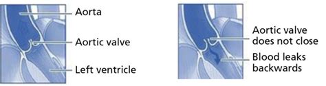 Aortic Regurgitation Leeds Teaching Hospitals Nhs Trust