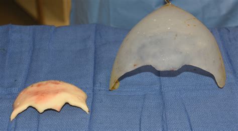 Custom Forehead Temporal Implant Replacement Dr Barry Eppley Indianapolis Explore Plastic Surgery