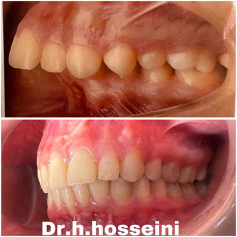 Before And After Orthodontic Treatment Without Surgery Using Tads 🤩