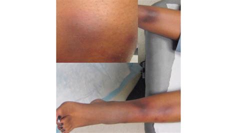 Panniculitis Types Symptoms Treatment And More