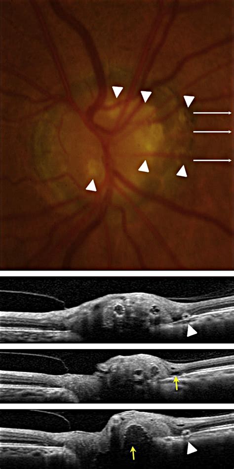Morphologic Characteristics Of Optic Nerve Head Drusen On Spectral