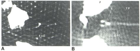 Figure 1 From Clinical Significance Of Partial Volume Averaging Of The