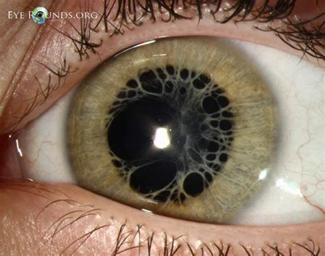Persistent Pupillary Membrane The University Of Iowa Ophthalmology