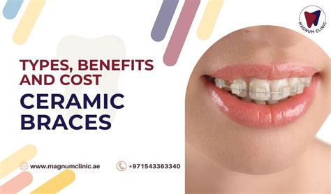 Ceramic Braces For Teeth Types Benefits And Cost