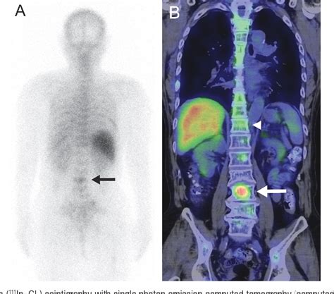 Figure 3 From A Case Of Focal Bone Marrow Reconversion Mimicking Bone Metastasis The Value Of