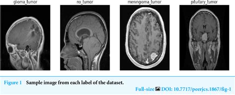 Figure 1 From Advancing Brain Tumor Detection Harnessing The Swin Transformers Power For