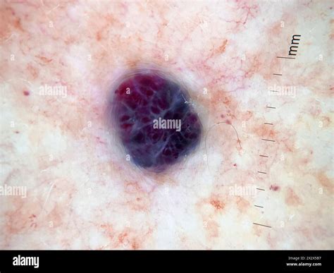 Dermatoscope Image Of A Hemangioma On A Patients Skin Haemangiomas
