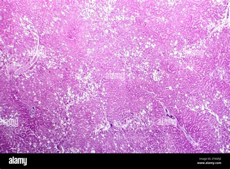 Photomicrograph Of Hepatic Steatosis Revealing Fat Accumulation In