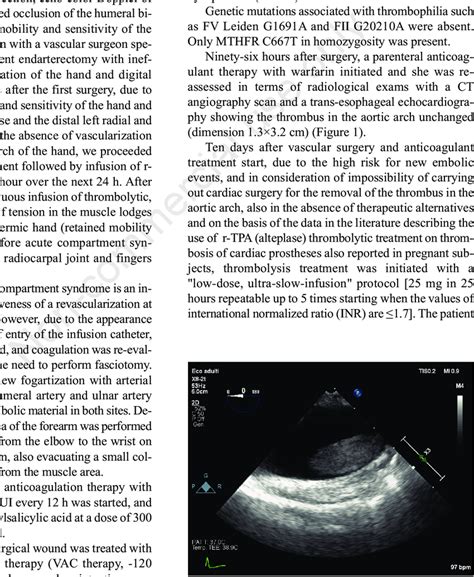 Trans Esophageal Echocardiography Showing Aortic Arch Mural Thrombus