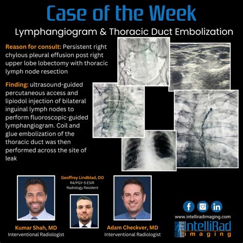 Cotw Lymphangiogram And Thoracic Duct Embolization Intellirad Imaging
