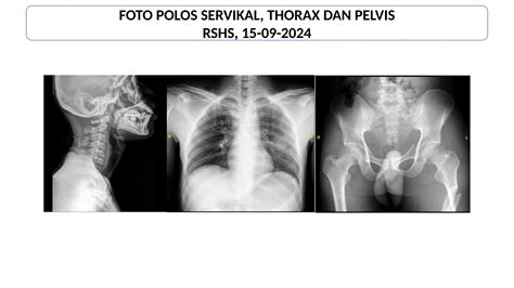 Pelvic Ring Injury Tile Classification A2 Dengan Hemodynamic Stabil