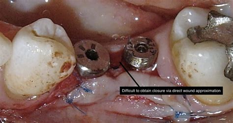 The Palacci Flap In 3d Dr Kevin Ho Medium