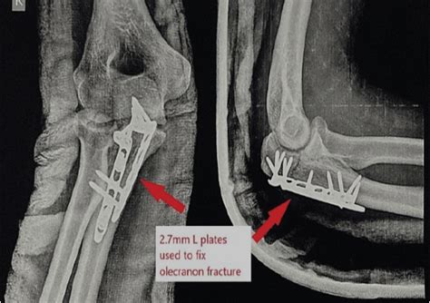 Olecranon Fracture Image Radiopaediaorg Olecranon Fractures