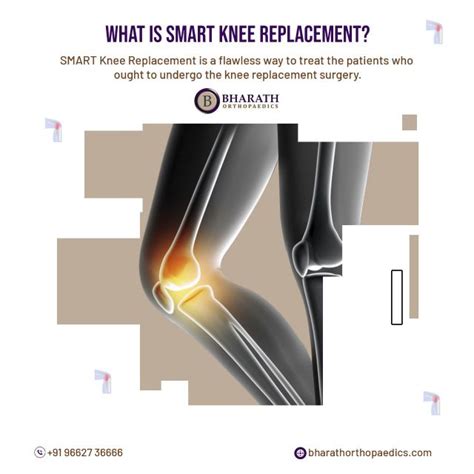 What Is Smart Knee Replacement Smart Knee Replacement Is A Flawless