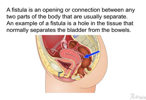Av Fistula For Dialysis