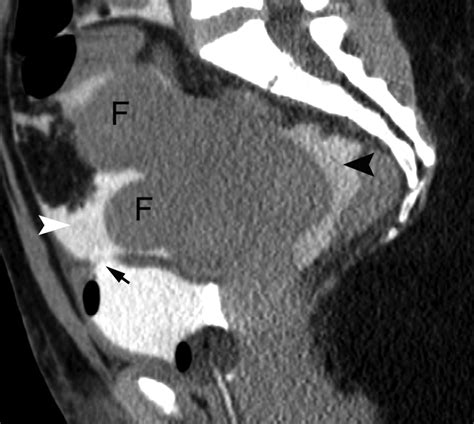 Ct Cystography With Multiplanar Reformation For Suspected Bladder