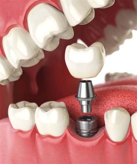 Single Tooth Replacement Dental Spa Of Broad Street